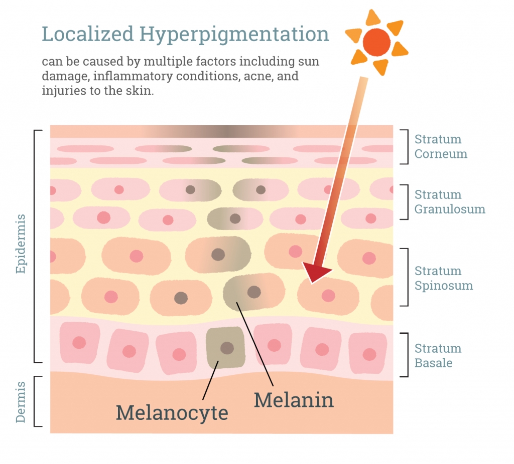 Dr Rachel Ho Causes Of Pigmentation Dr Rachel Ho Causes Of Pigmentation