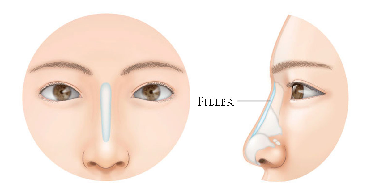 Fillers Gone Wrong: Telltale Signs of Too Much Filler Injections