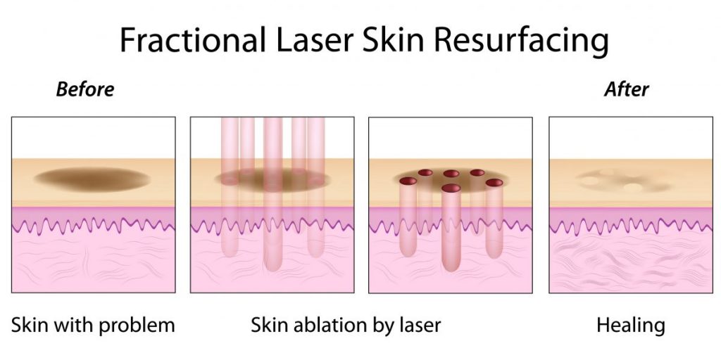 How to Get Rid of Large Pores: Myths and Truths - Dr Rachel Ho