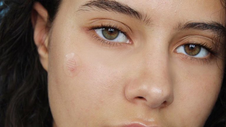 Fungal Acne is Not Acne At All: Malassezia Folliculitis Explained