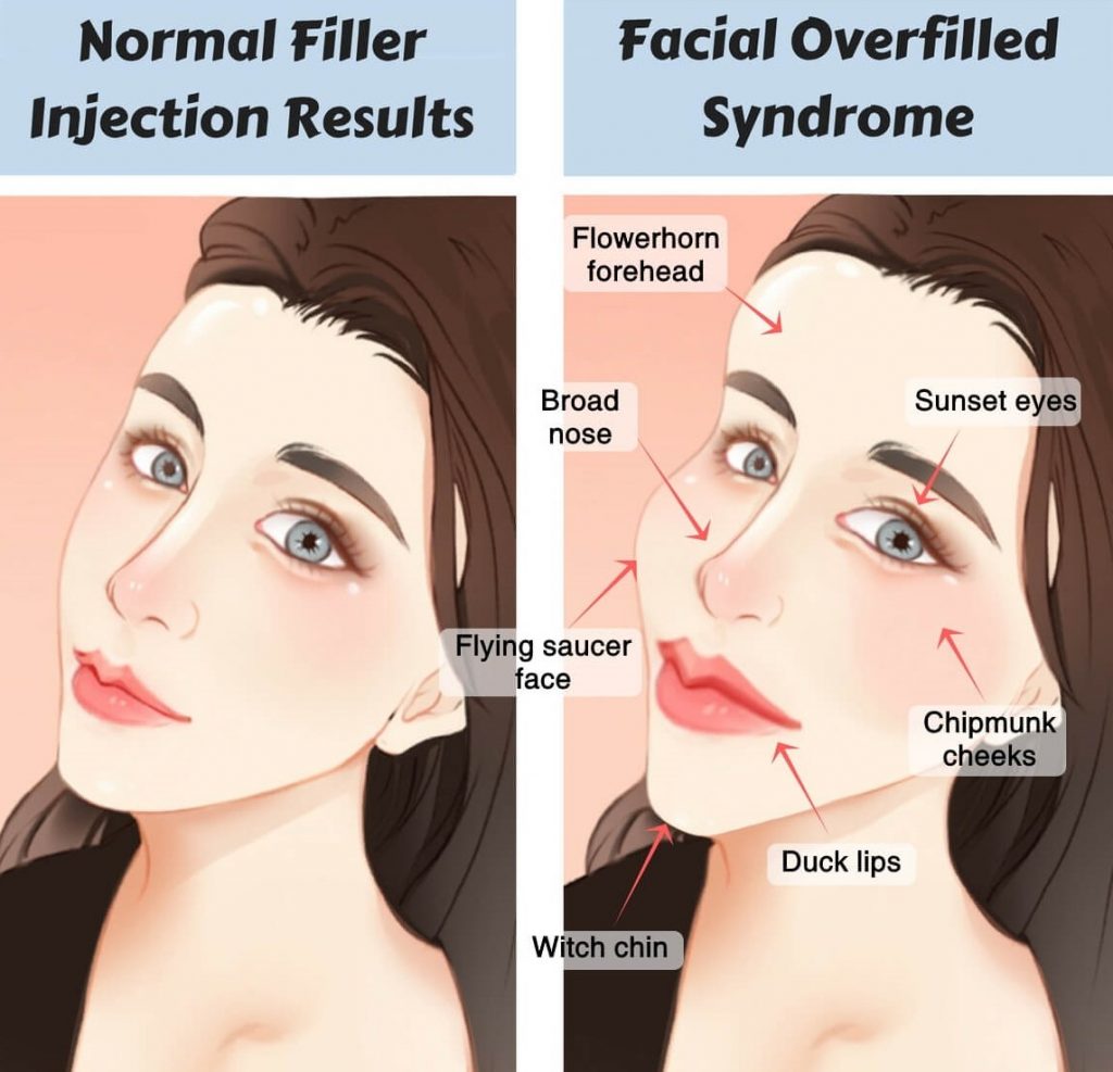 Dr Rachel Ho Fillers Gone Wrong Telltale Signs Of Too Much Filler Dr Rachel Ho Fillers Gone Wrong Telltale Signs Of Too Much Filler
