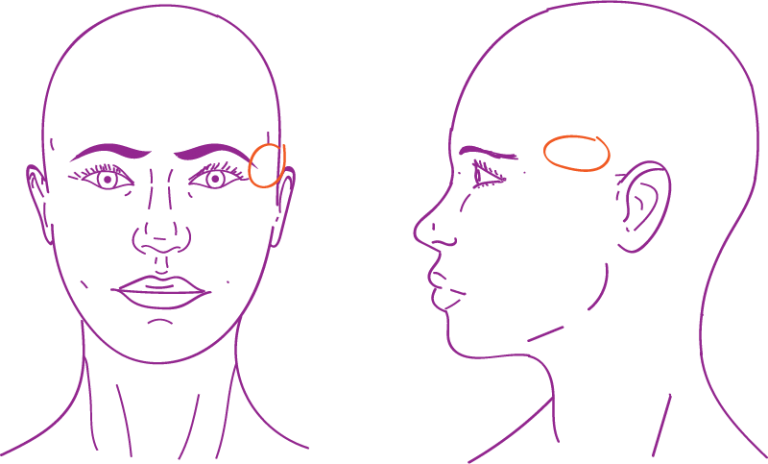 Temple Fillers for Hollow Temples - Dr Rachel Ho