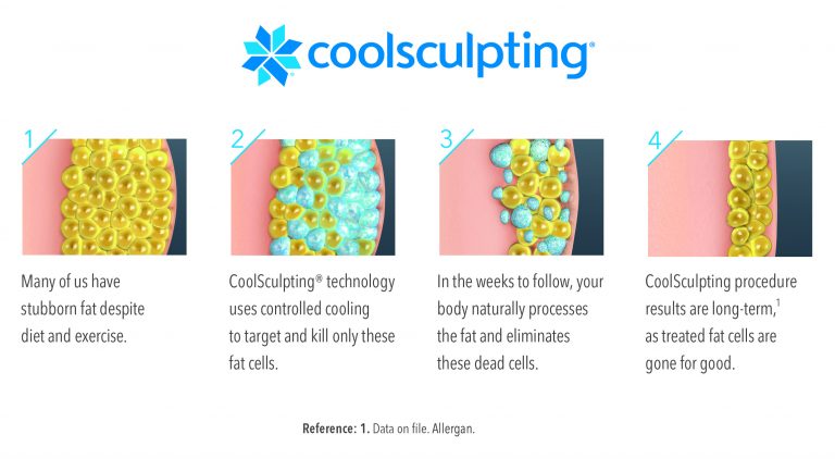 Paradoxical Adipose Hyperplasia: A Complication of Coolsculpting Fat ...
