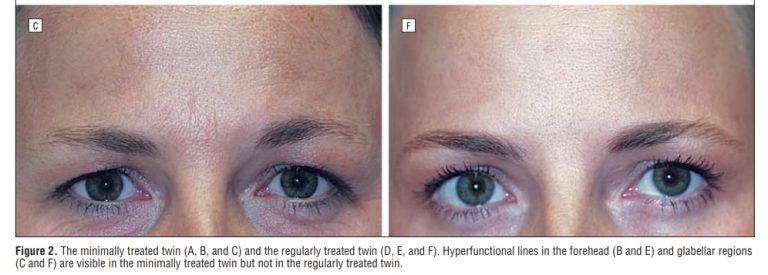 What are the effects of long term Botulinum toxin injections? - Dr ...
