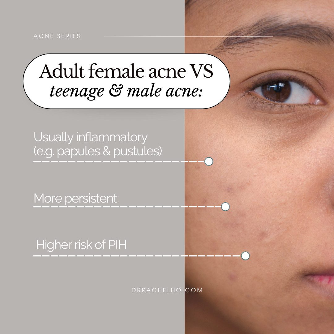 Adult Female Acne: A Doctor Explains (Singapore) - Dr Rachel Ho